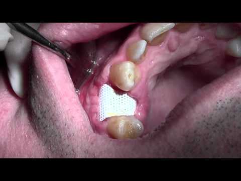Bone Grafting #5 Site with Mineross/Cytoplast d-PTFE, 2 Week Post-op
