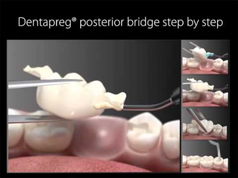 Dentapreg Posterior Bridge Training