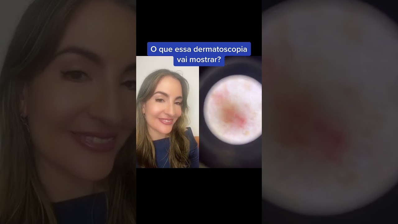 Como é a dermatoscopia ?