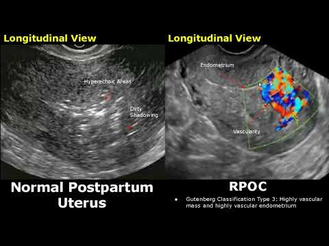 Postpartum Uterus Ultrasound Normal Vs Abnormal Image Appearances | RPOC | Retained Placenta USG
