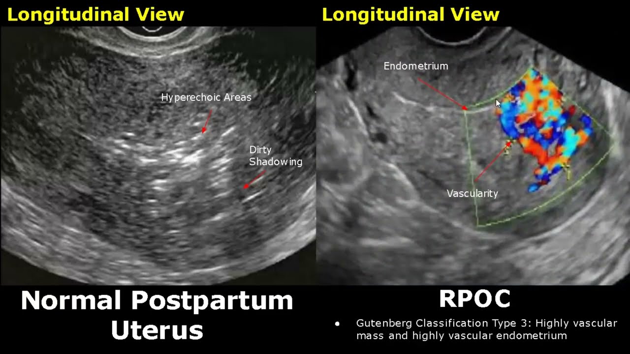 Postpartum Uterus Ultrasound Normal Vs Abnormal Image Appearances | RPOC | Retained Placenta USG