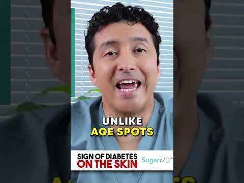 Shin Spots | Sign of Diabetes on The Skin