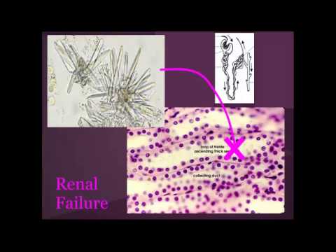 Tumor Lysis syndrome: "EM in 5"