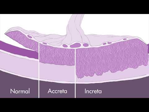 Placenta Accreta Spectrum What to Expect, Placenta Accreta Ireland