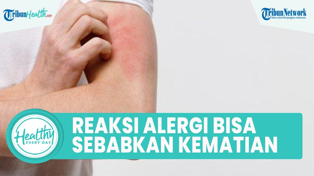 Sering Dianggap Remeh, Reaksi Alergi Ternyata Bisa Akibatkan Kematian ...