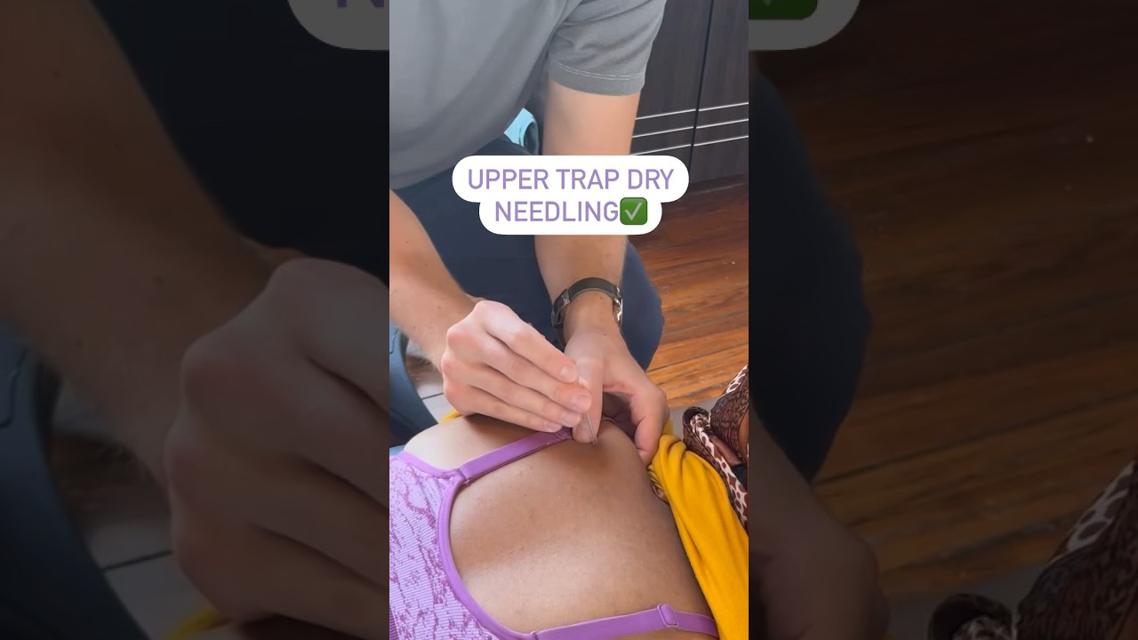 Upper Trap Dry Needling🪡 #nashville #nashvilletn #chiropractor#chiropractic#nashvillechiropractor
