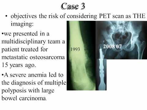 Diagnostic accuracy of FDG PET imaging for the detection of metastatic paediatric cancer