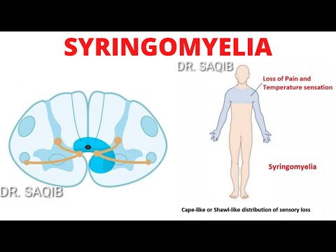 Syringomyelia