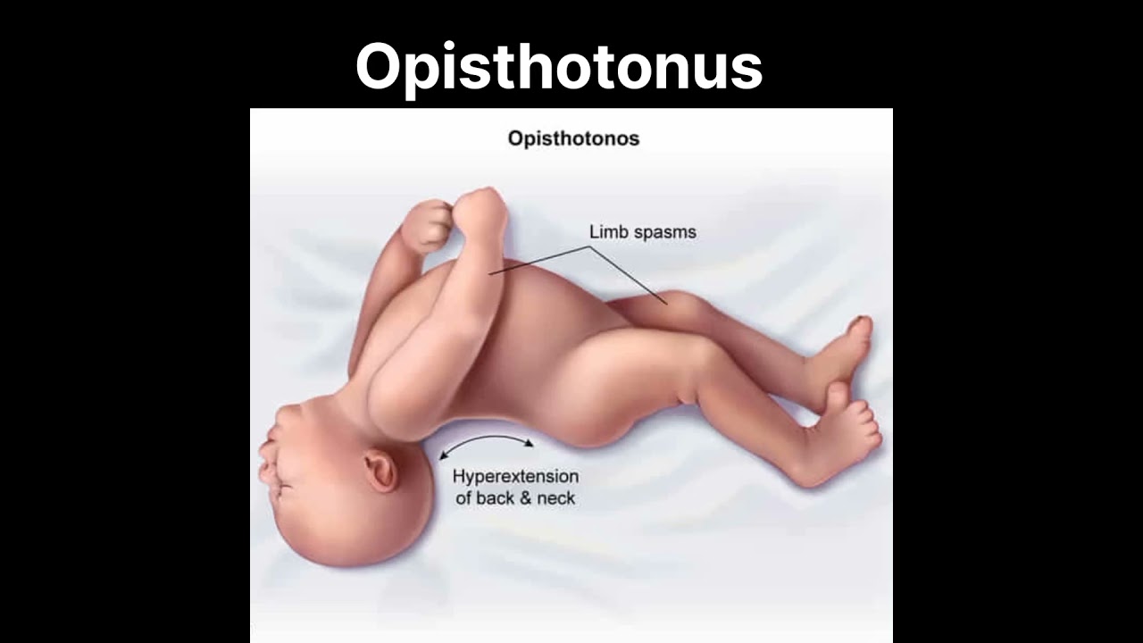 Opisthotonus #opisthotonus