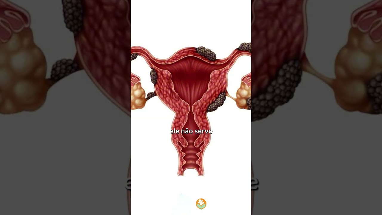 Dra., Como sei que tenho ENDOMETRIOSE? Clinifert Clinica Reprodução Humana Florianópolis
