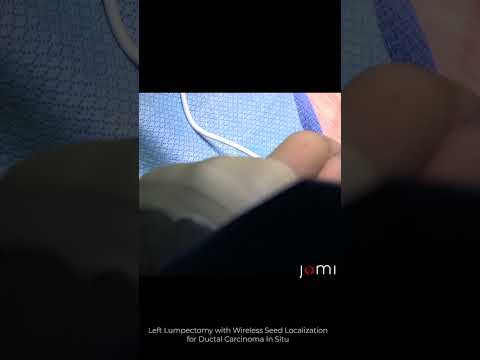 Left Lumpectomy with Wireless Seed Localization for Ductal Carcinoma In Situ