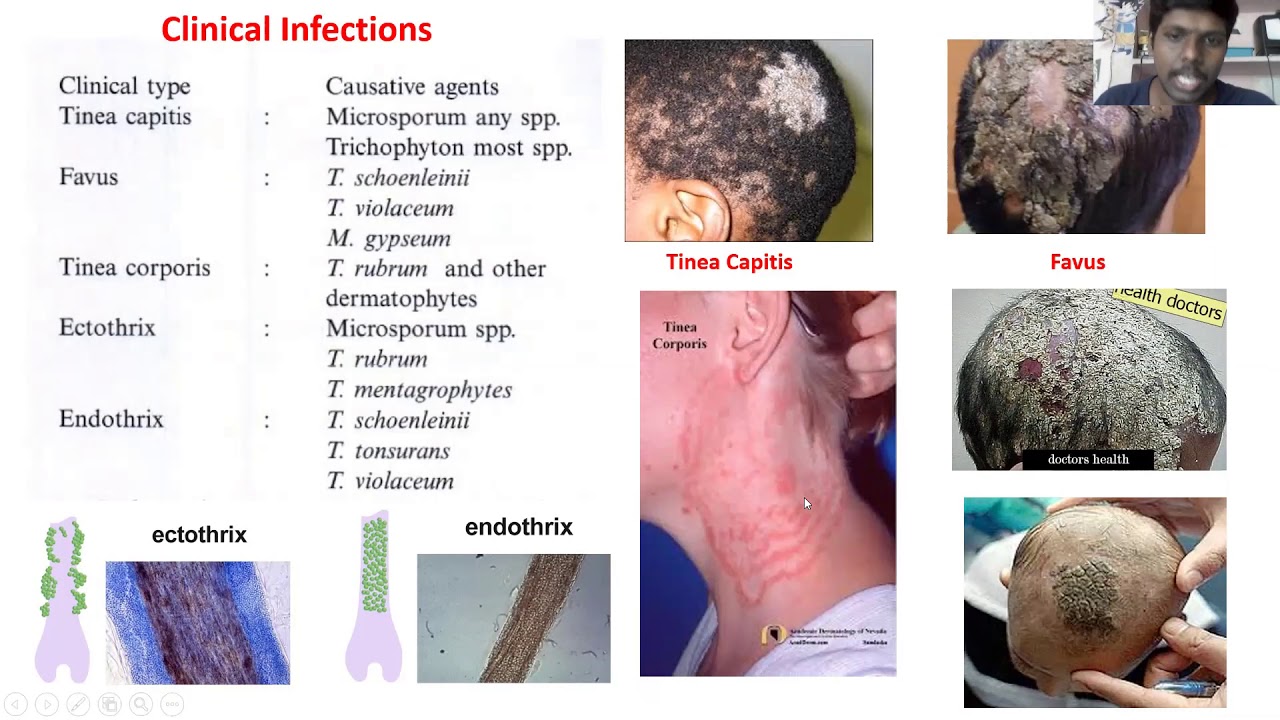 7. Superficial Mycoses: Dermatophytes
