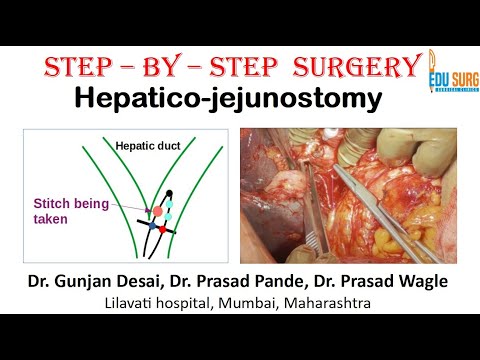 Step-by-step Surgery - Roux-en-Y hepaticojejunostomy -benign biliary stricture(post cholecystectomy)