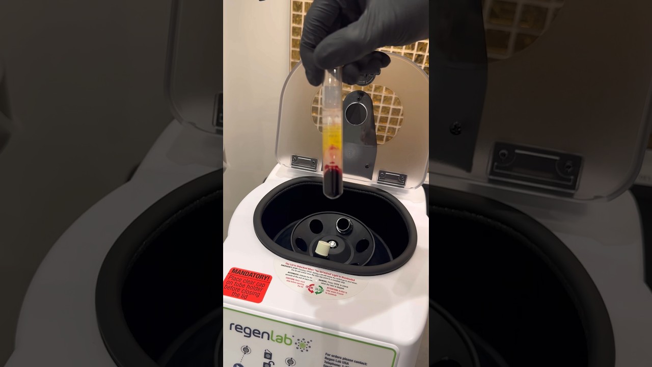 PRP which is Platelet Rich Plasma mixed with 40mg of Hyaluronic Acid #prp #hyaluronicacid #drsknn