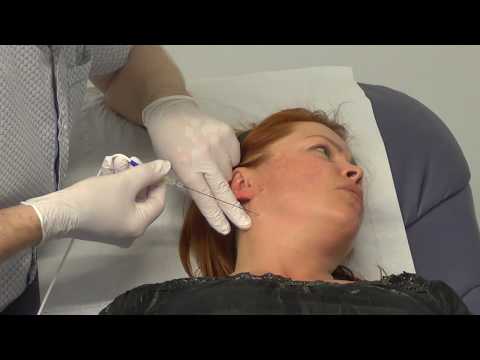 EndodermalRadiofrequency