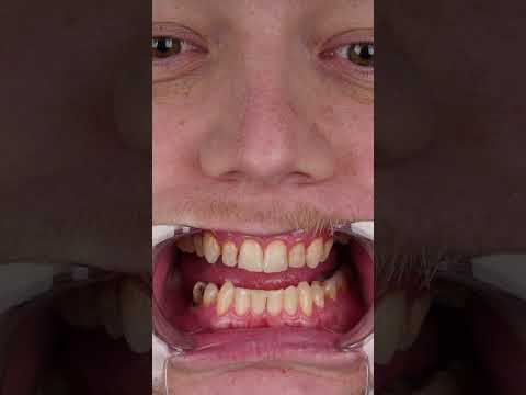 Fasten your seatbelts for this smile makeover!