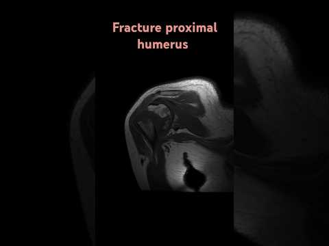 Fracture proximal humerus MRI -Shoulder #anatomy