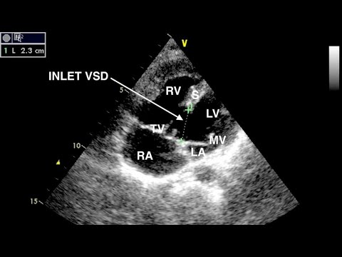 Eisenmenger Syndrome Echocardiography