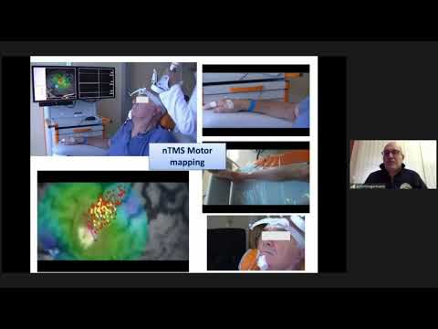 Modern Treatment of Brain Arteriovenous Malformations A Revisitation of the concept of eloquence
