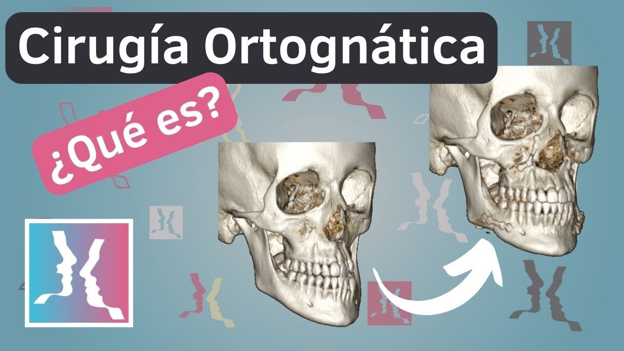 ¿Qué es la cirugía ortognática?