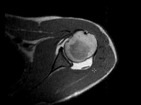 Labral tear in 20 year old