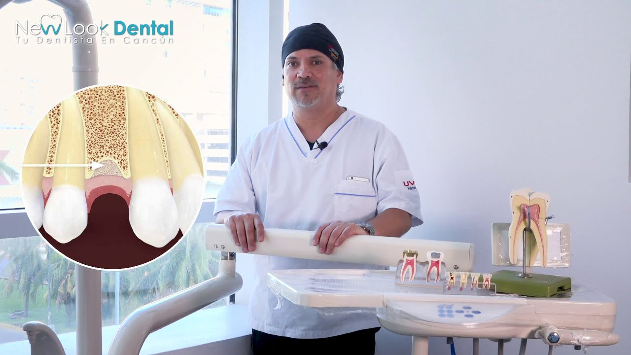 Brackets después de los 30 años ¿Recomendado? 🤔 Los brackets en adultos sí son posibles!