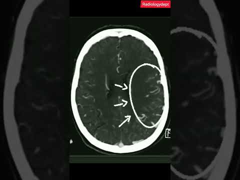 Arteriovenous malformation #avm #shorts #shortvideo