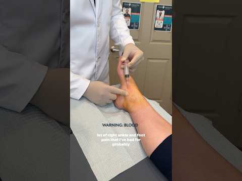 ⚠️ Warning: Blood-PRP proccedure for torn and ruptured tendon. #texas #feet