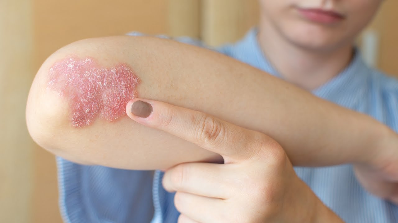 Psoriasis Explained by NIAMS