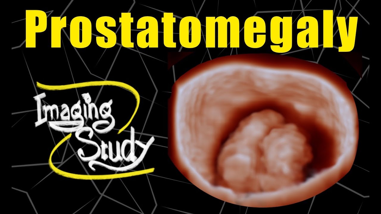 Understanding Prostatomegaly: Insights from Ultrasound Imaging | Galaxy.ai
