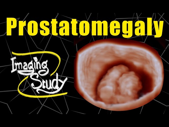 Understanding Prostatomegaly: Insights from Ultrasound Imaging | Galaxy