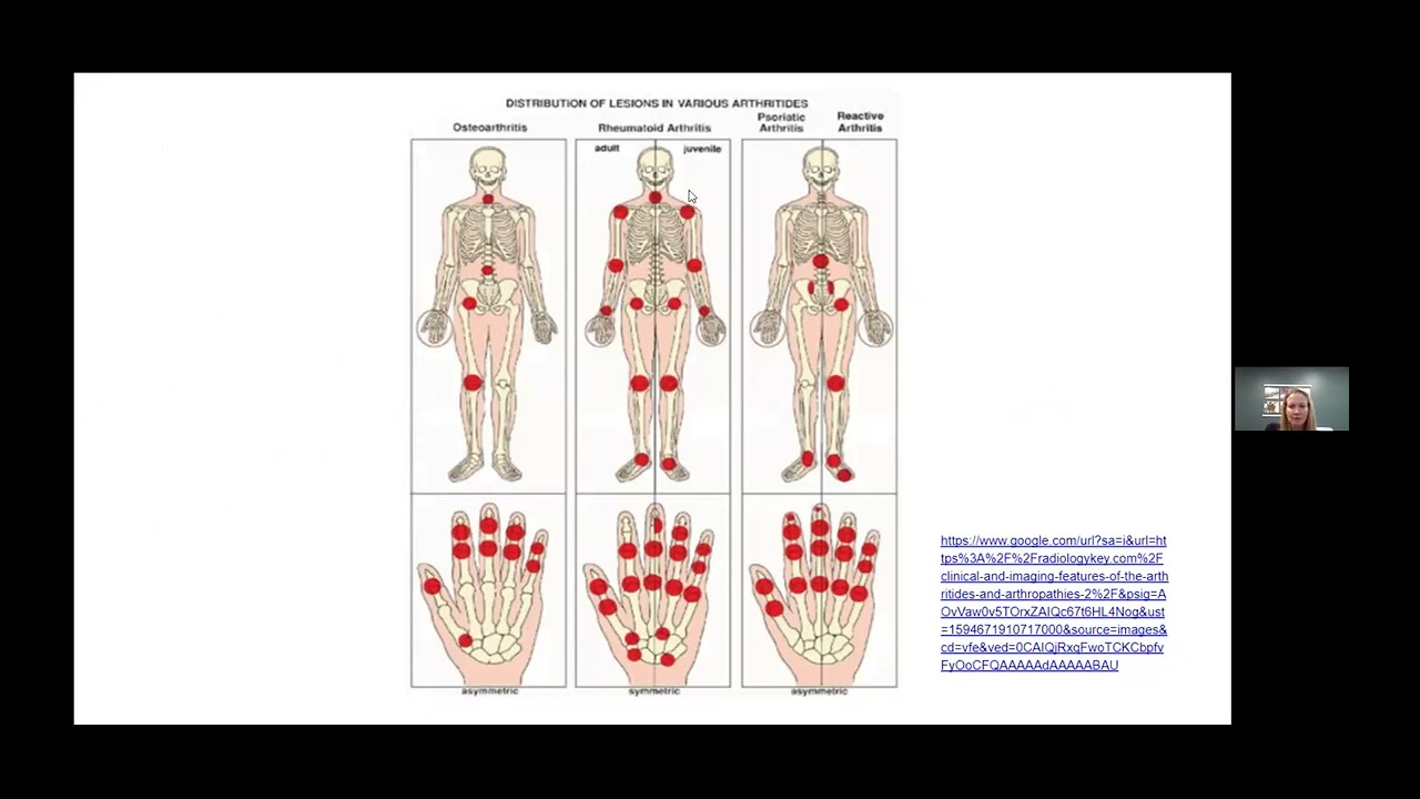 Wellness Webinar: Understanding Arthritis & Joint Pain