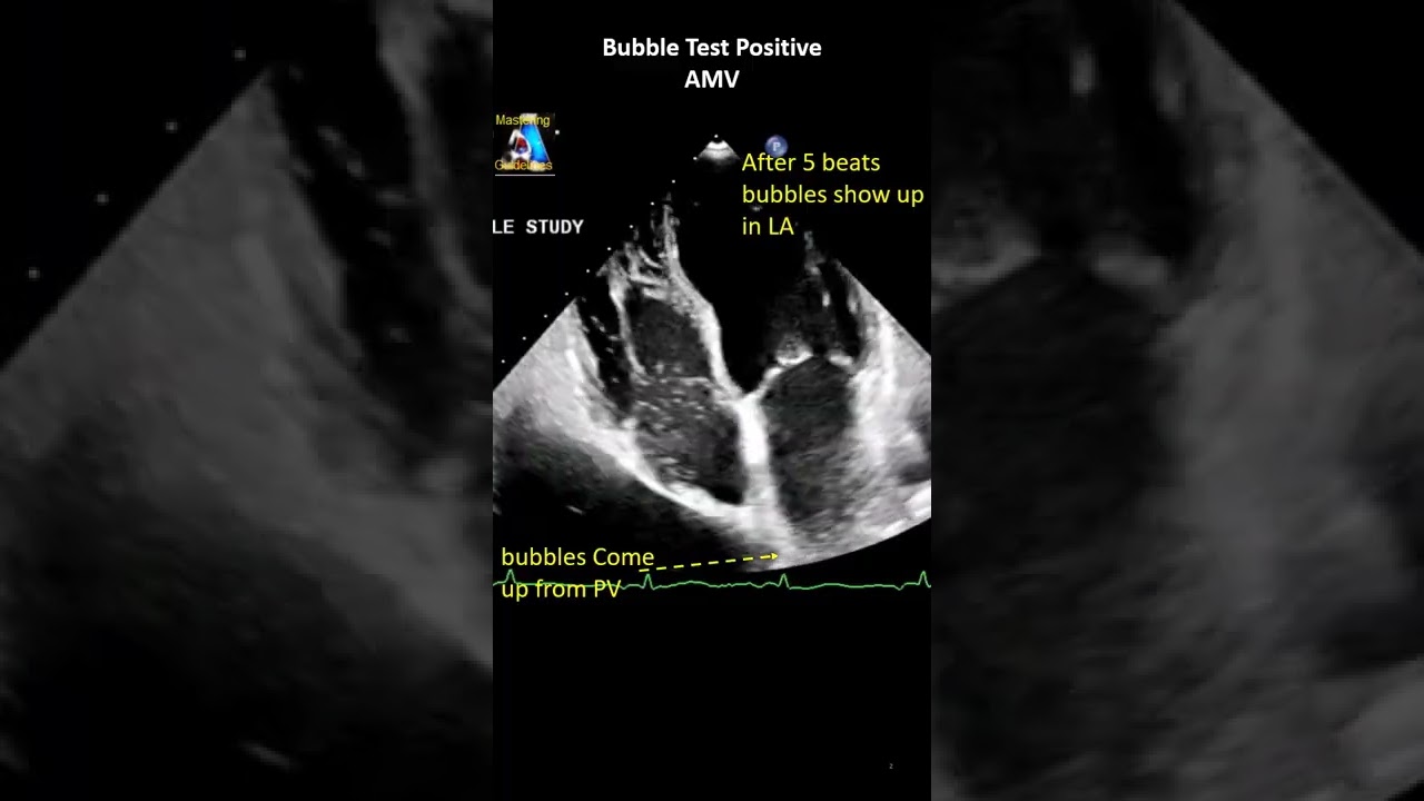 Arteriovenous Malformation (AVM): Bubble Test