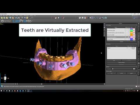 Using Blue Sky Plan for Bone Reduction Guide, Drilling Guide, and Immediate Prosthesis