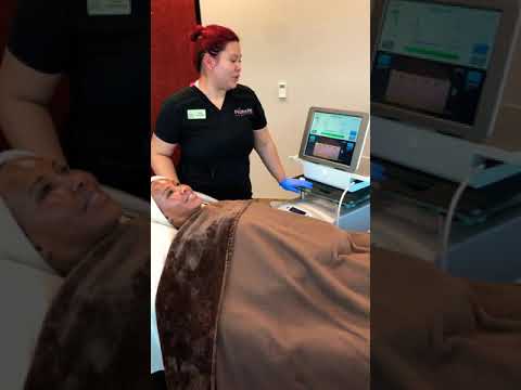 Ematrix Sublative Treatment