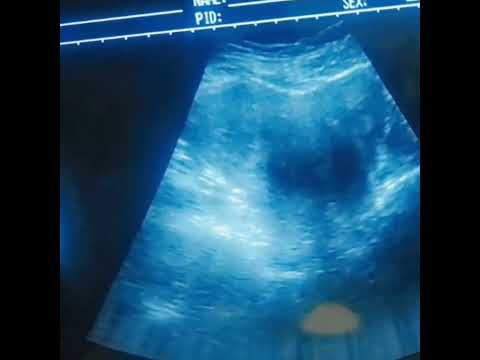 tow gestional sac in ultrasound one Normal and one abnormal