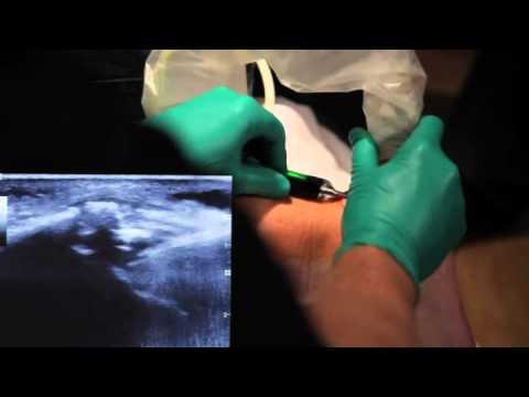 FAST Procedure - Achilles Tendon