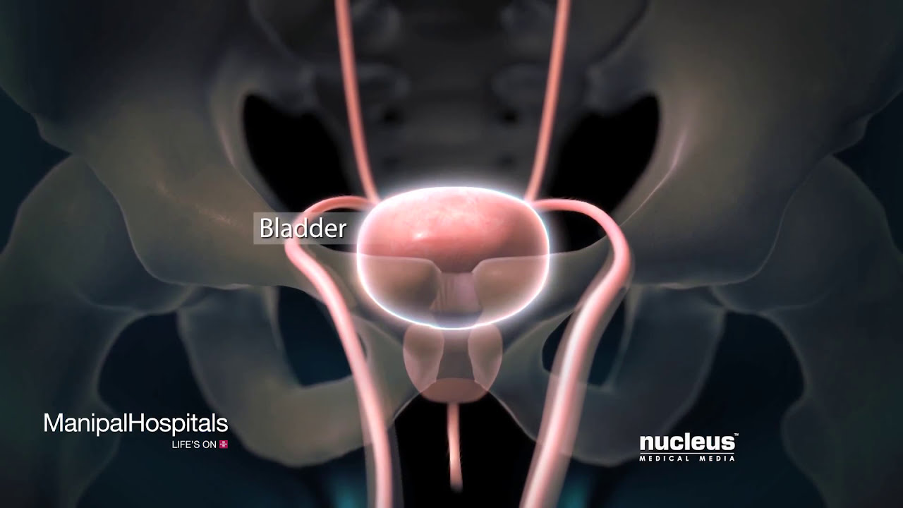 Robotic Radical Cystectomy For Male | Robotic Cystectomy | Cystectomy - Manipal Hospitals