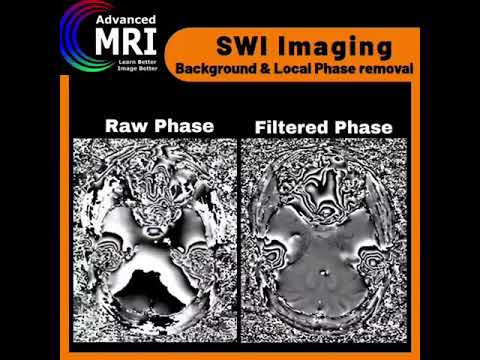 SWI Phase image processing