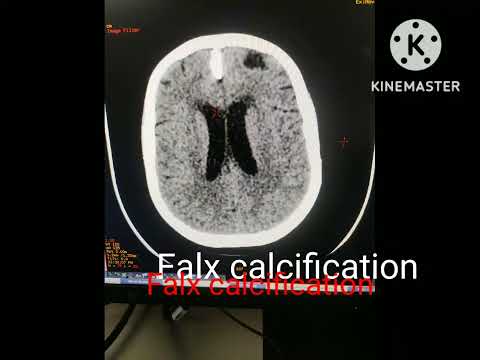 Falx calcification ( Brain )