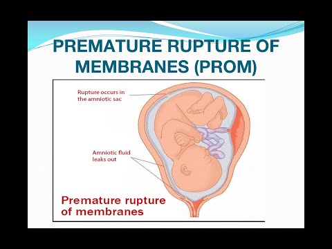 Premature rupture of membranes (PROM)