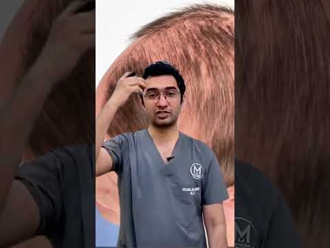 Understanding Finasteride Side Effects: What You... #finasteride #sideeffects #shorts #drmalaymehta