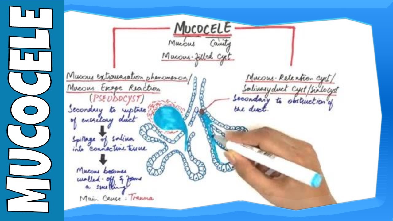 Mucocele - Types, Clinical Features, Histopathalogic features & Treatment