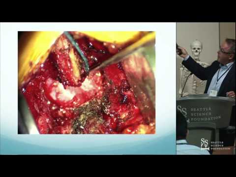 Practical Use of Interlaminar Stabilization In a Spine Surgeon’s Practice - Darrell Brett, MD