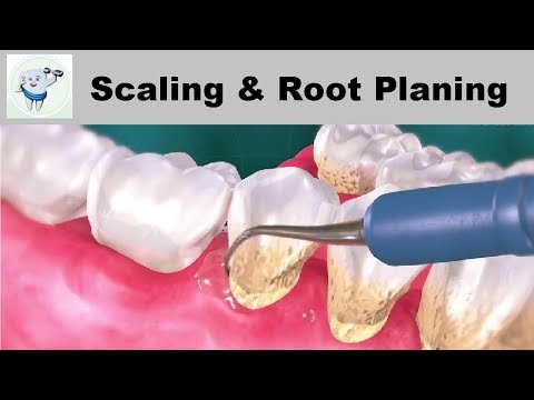 Dental Scaling and Root Planing || Treatment of Gum Disease
