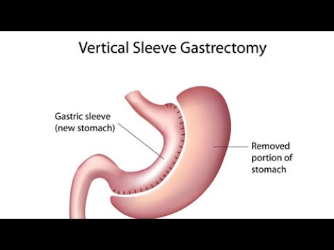 CPT code for Gastrectomy - simplify medical coding