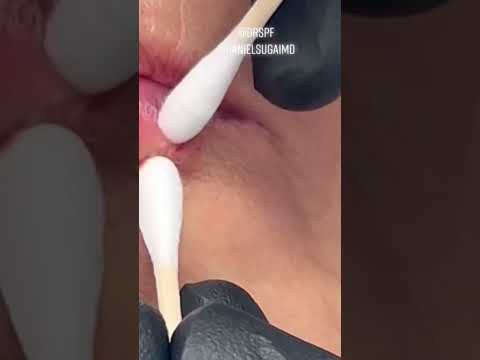 #shorts Milia Extraction