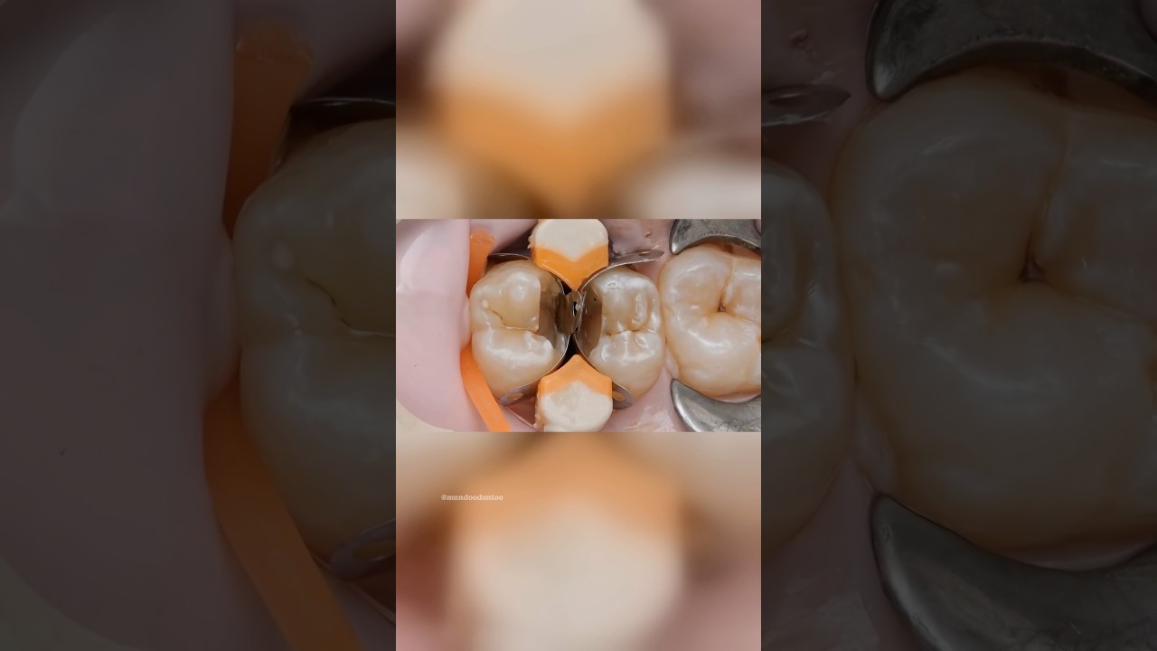 Class II Direct Composite — Step-by-Step Under Rubber Dam | 3D Fusion Sectional Matrix #shorts