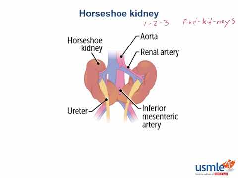 USMLE-Rx Express Video of the Week: Horseshoe Kidney