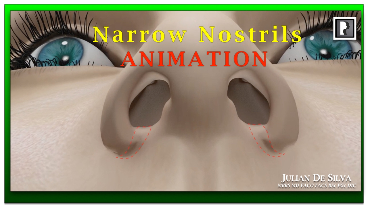 Rhinoplasty Animation - How can Wide Nostrils be Narrowed?